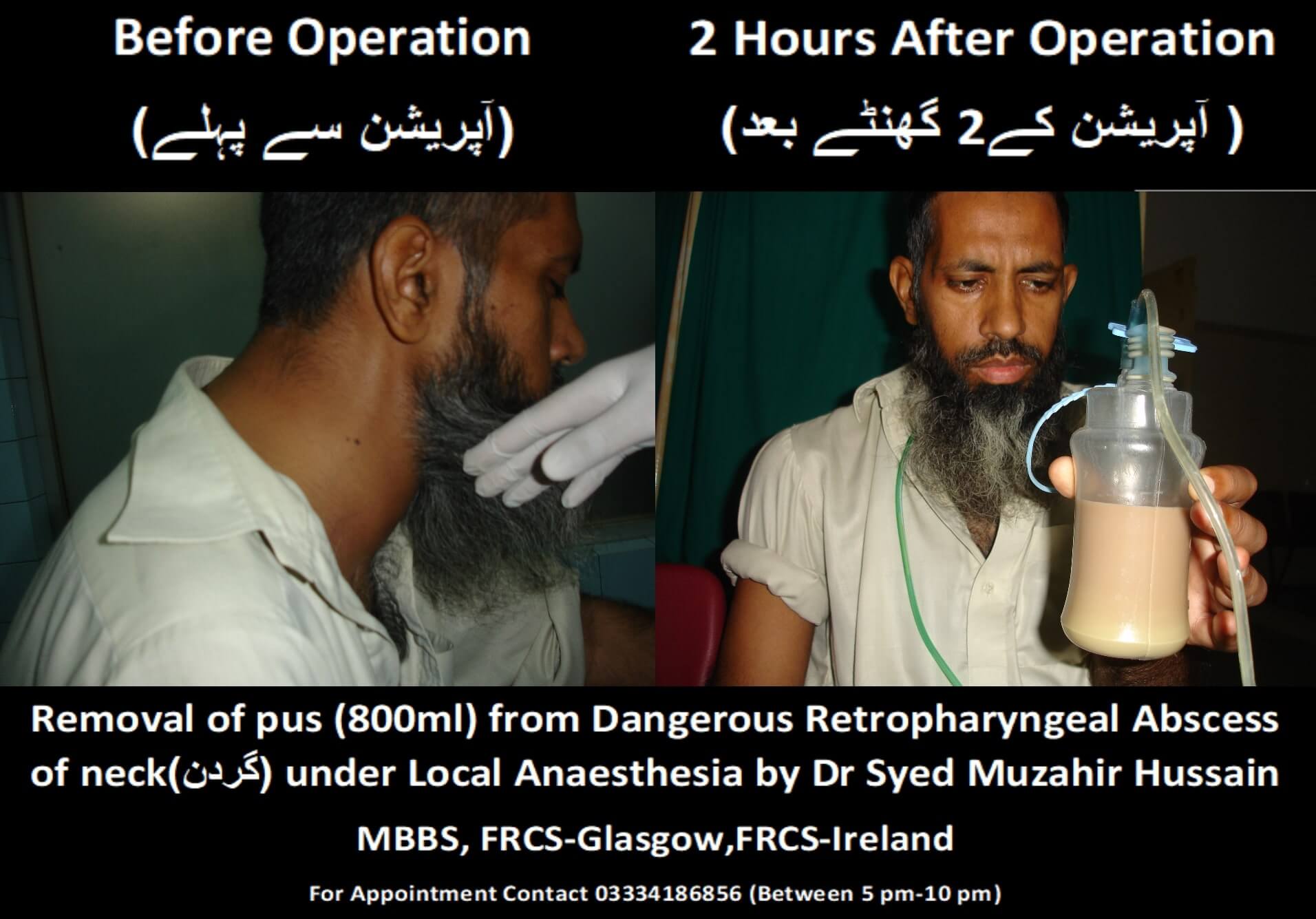 Drainage of Retropharangeal Abscess - Dr Syed Muzahir